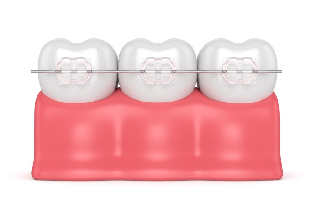 Invisalign Braces in Penang - Millennium Care Dental